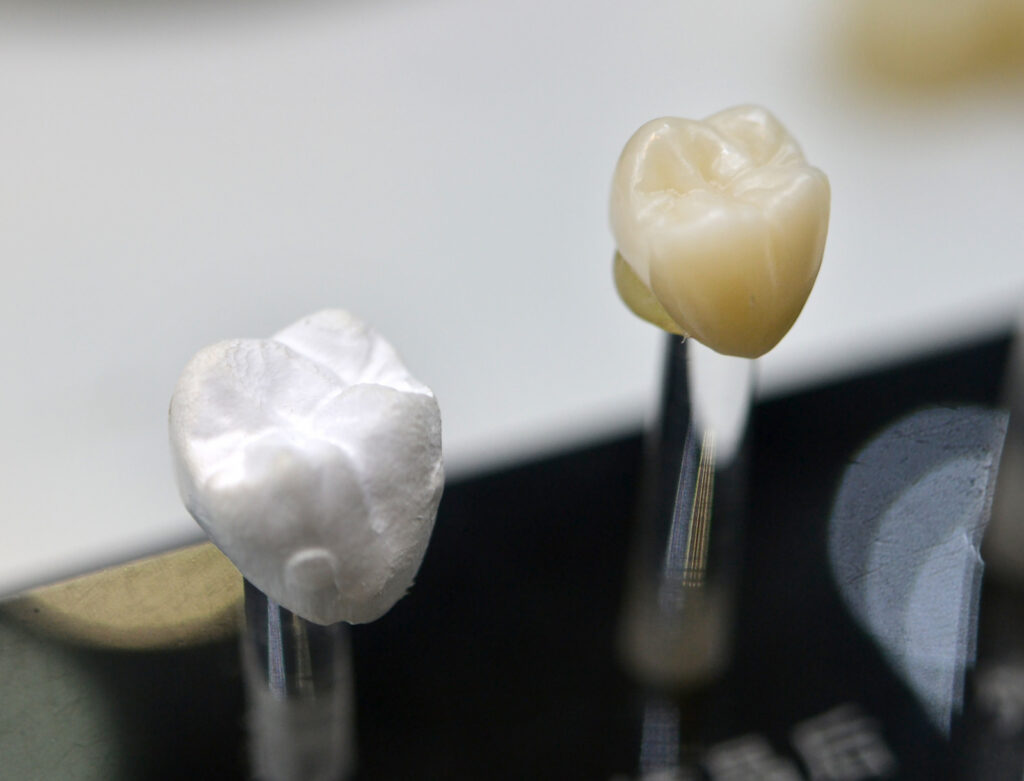 What is a CEREC Crown? Benefits, Process, and Key Facts