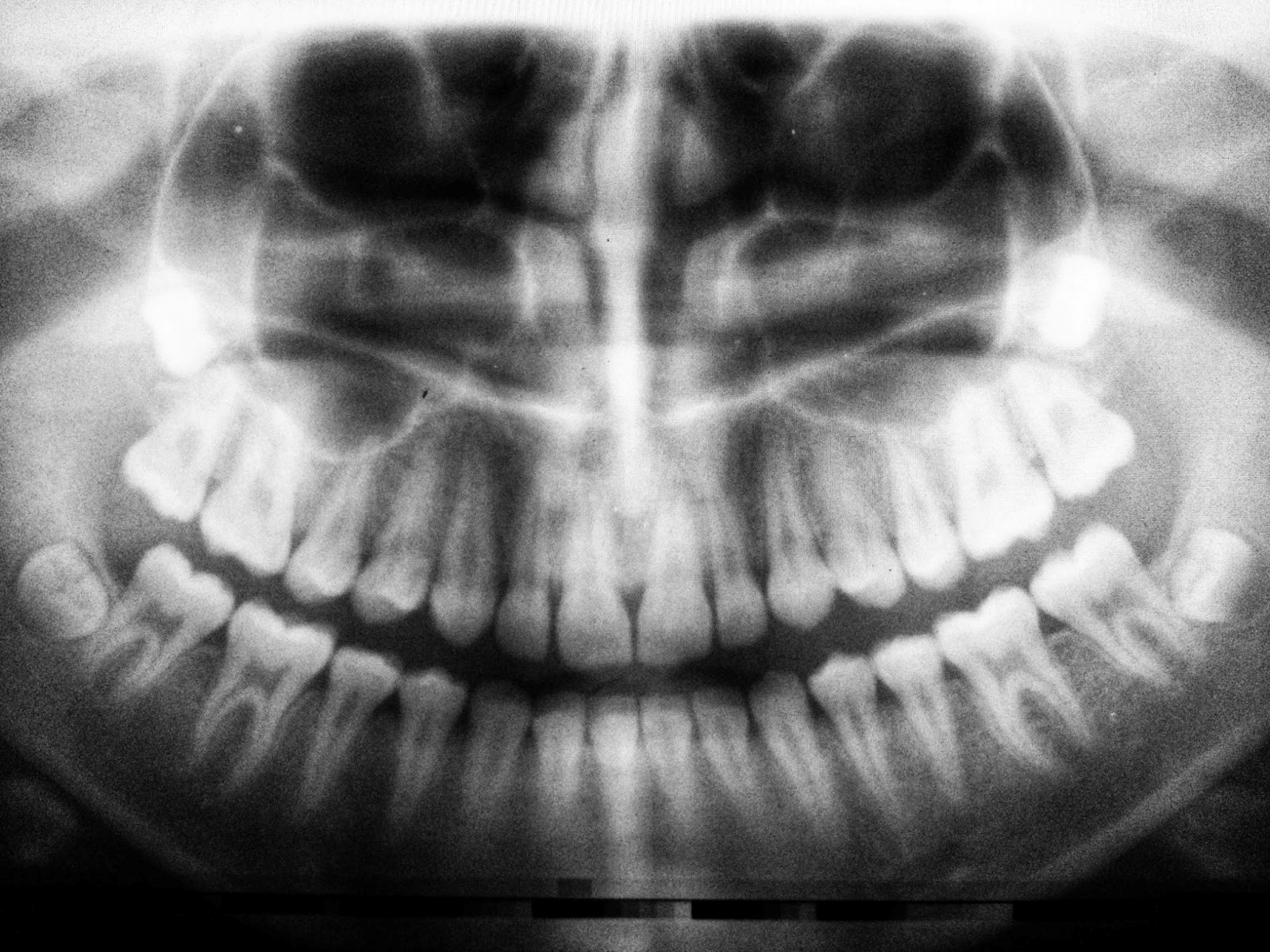 Different Types Of Dental Cements Used In Orthodontics